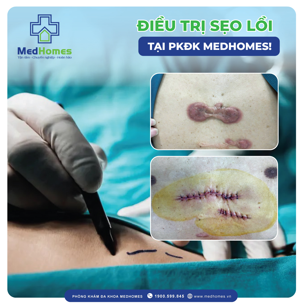 Điều trị sẹo lồi tại Hải Phòng